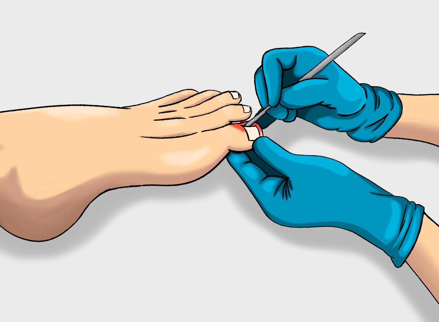 Tout savoir sur l'ongle incarné